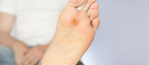 The Link Between Diabetes and Unhealed Foot Wounds | Washington Vascular