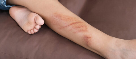 Understanding the Different Types of Wounds and Their Treatments ...